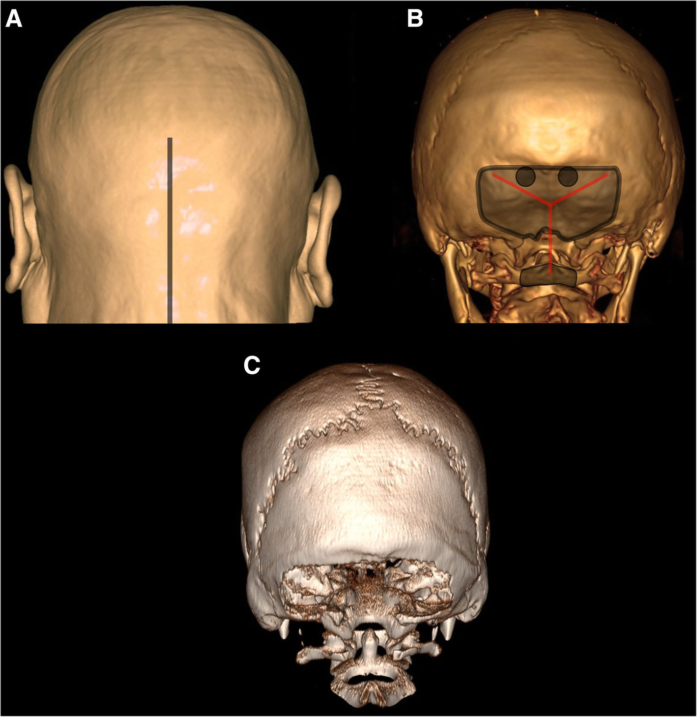 Decompressive craniectomy for acute ischemic stroke | SpringerLink