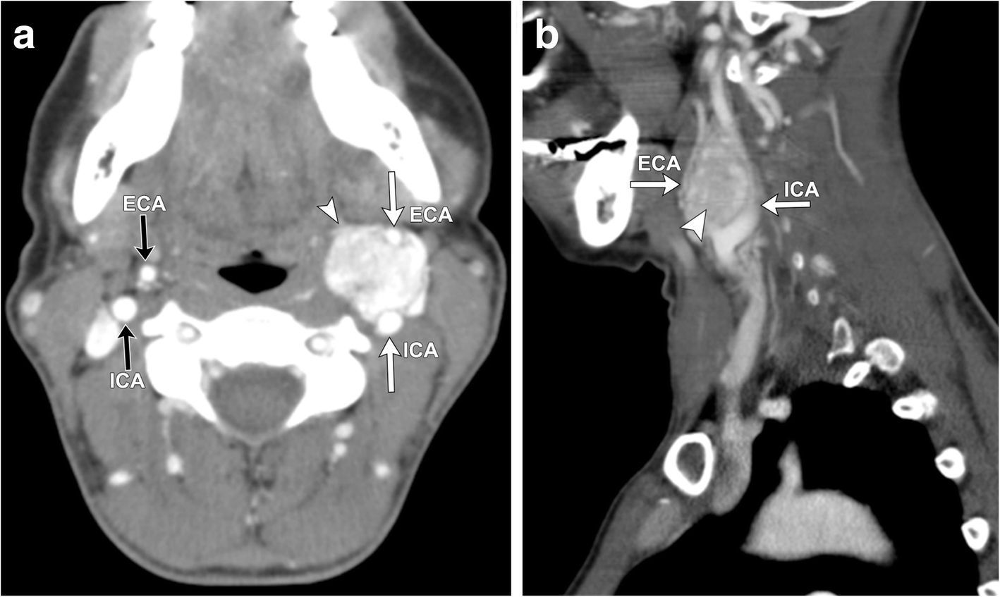 Multimodality imaging of paragangliomas of the head and neck | SpringerLink