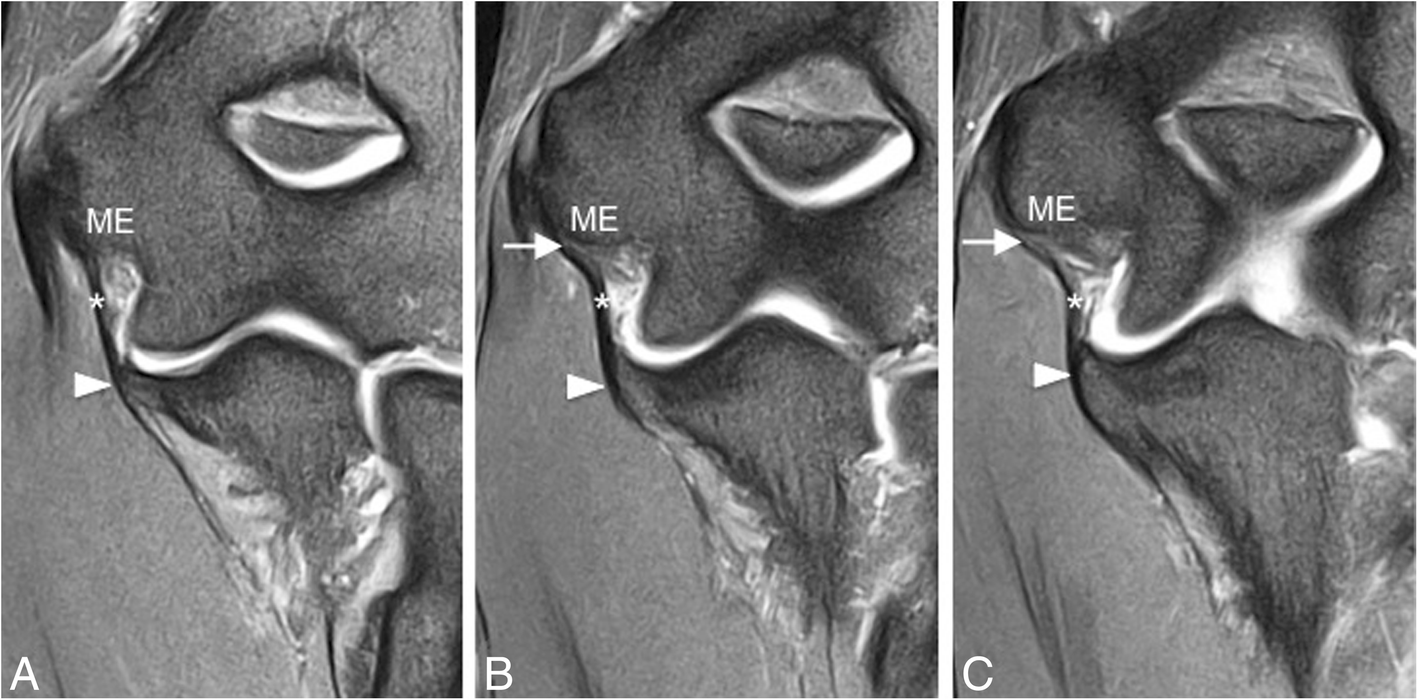 The elbow: review of anatomy and common collateral ligament complex ...