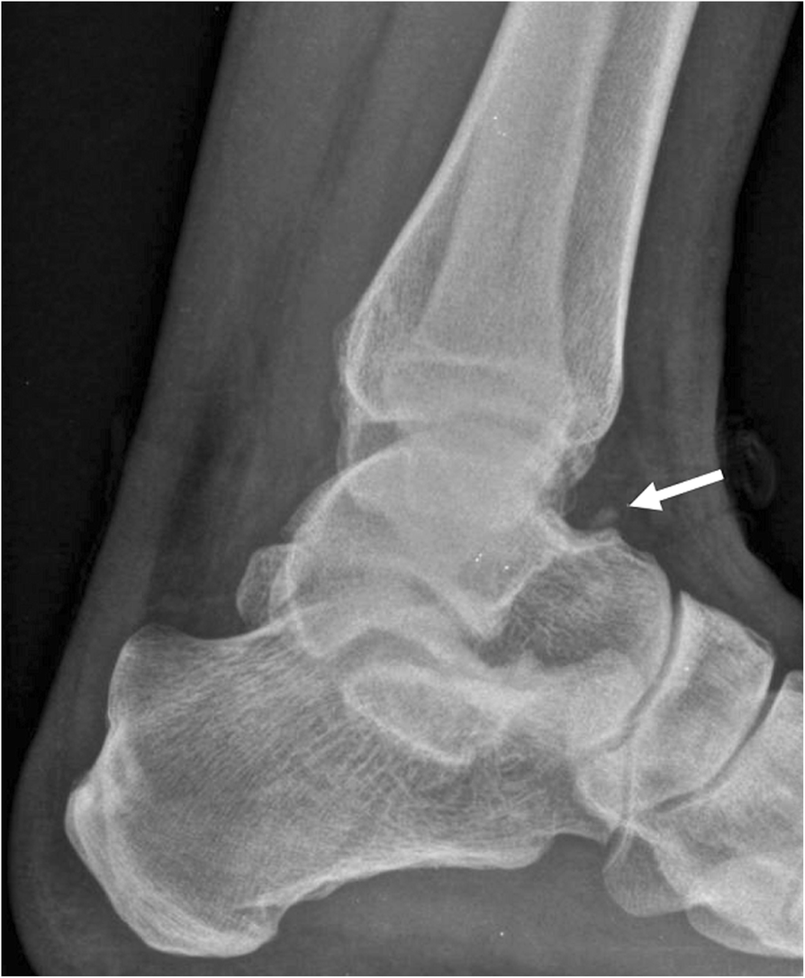 Anatomical variation in the ankle and foot: from incidental finding to ...