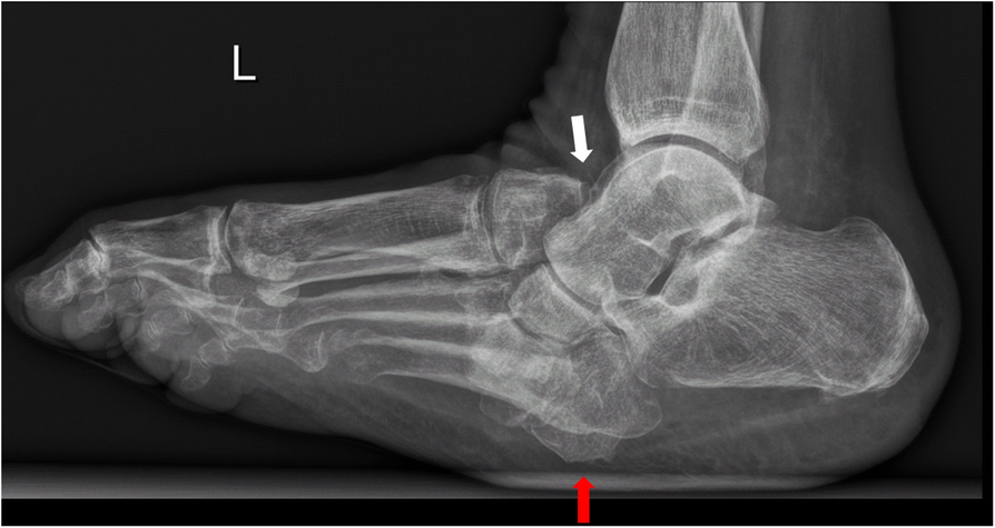The Charcot foot: a pictorial review | SpringerLink
