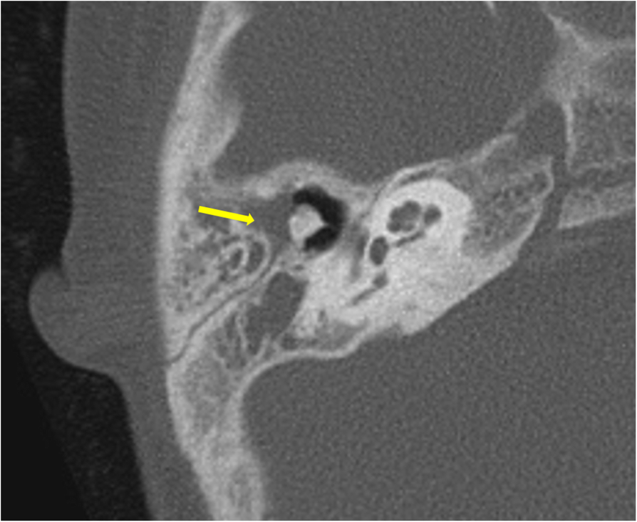 HRCT imaging of acquired cholesteatoma: a pictorial review | SpringerLink