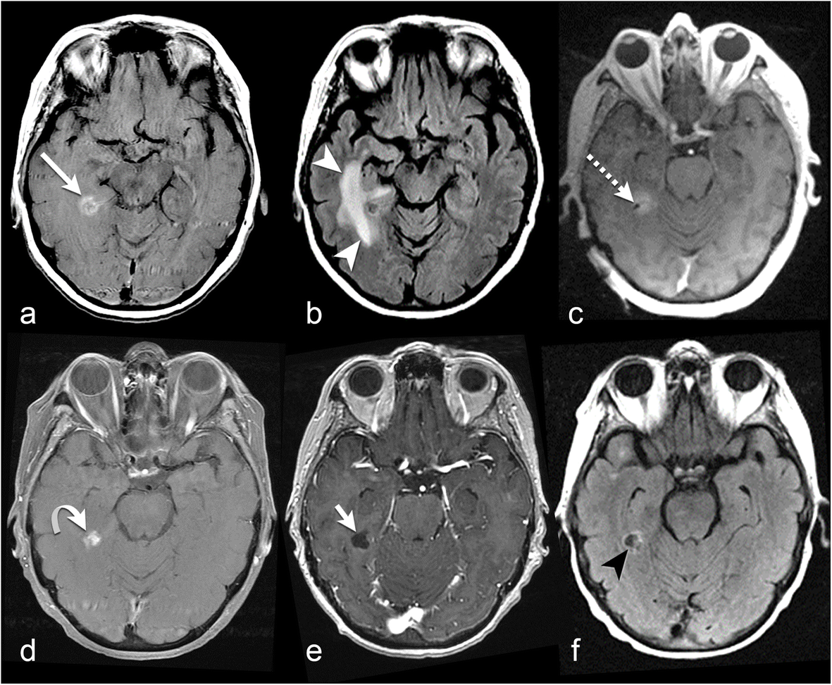 Neurosurgical applications of MRI guided laser interstitial thermal ...