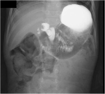 Successful combination of endoscopic pyloromyotomy and balloon ...