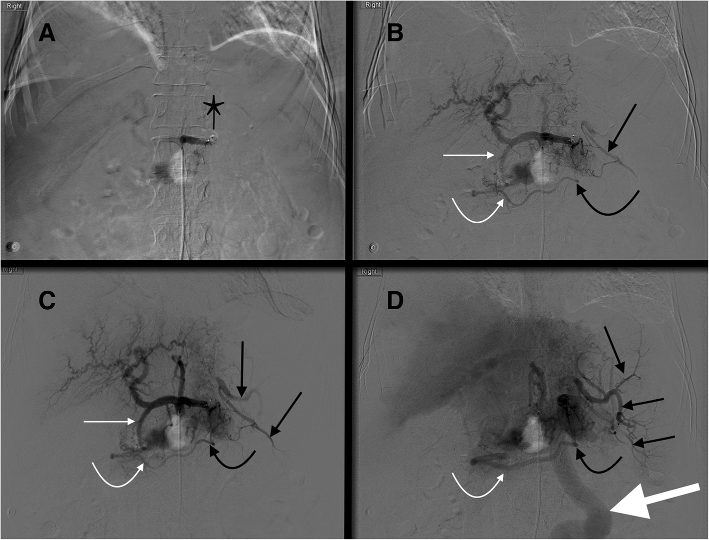 Review of proximal splenic artery embolization in blunt abdominal ...