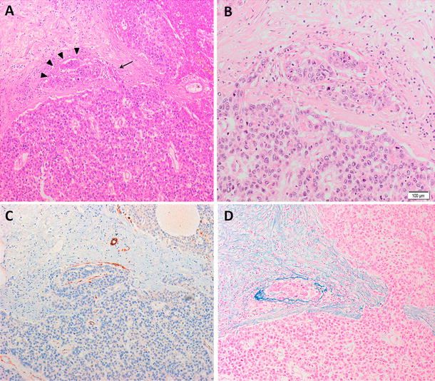 A Systematic Review of Microvascular Invasion in Hepatocellular ...