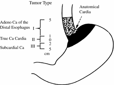 What’s the Best Way to Treat GE Junction Tumors? Approach Like Gastric ...