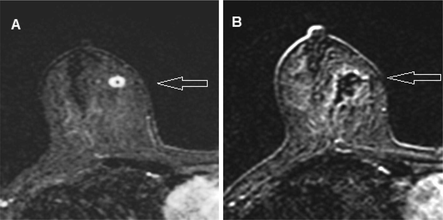 Phase 2 Open-Label Trial Investigating Percutaneous Laser Ablation for ...