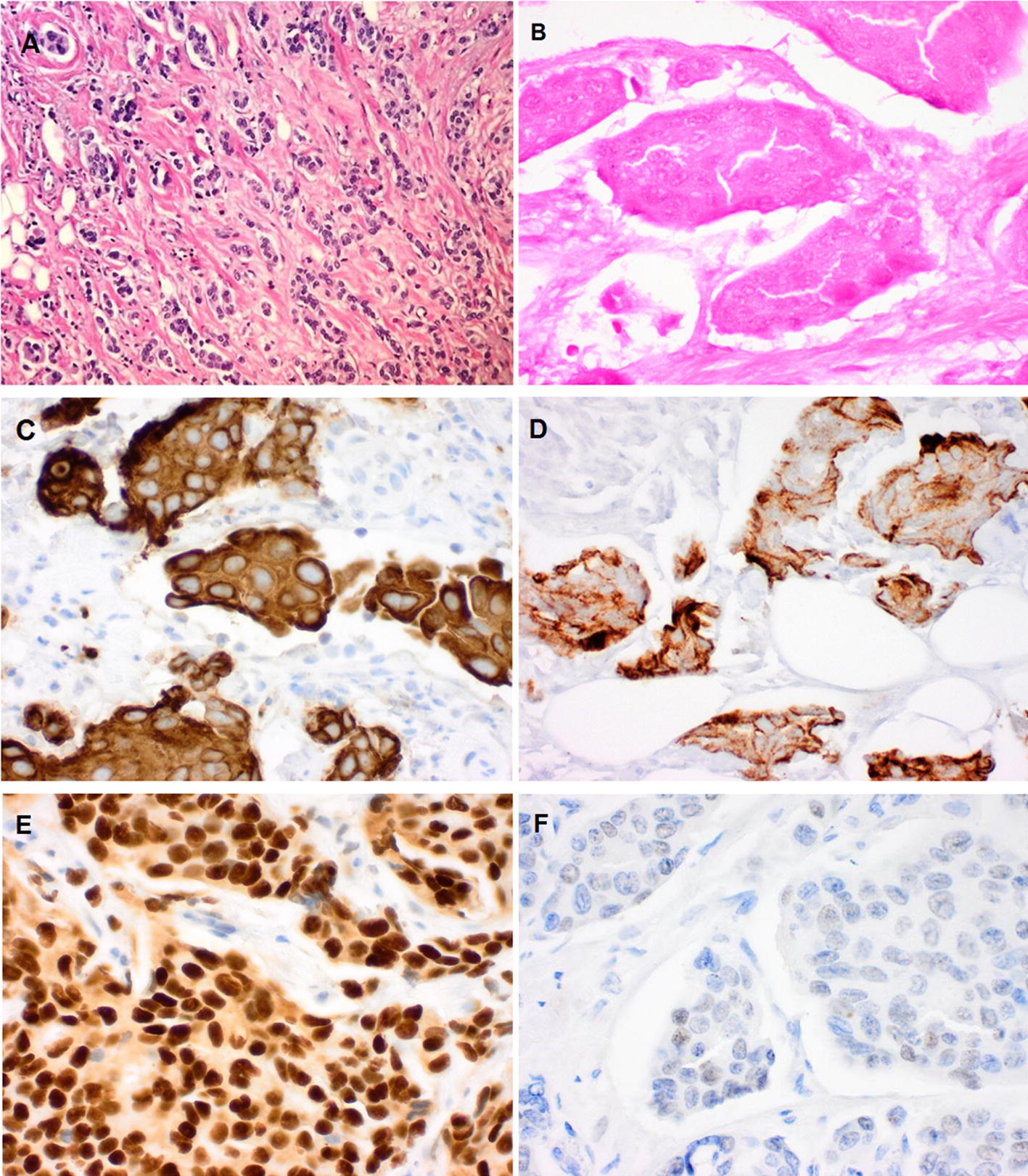 Phase 2 Open-Label Trial Investigating Percutaneous Laser Ablation for ...