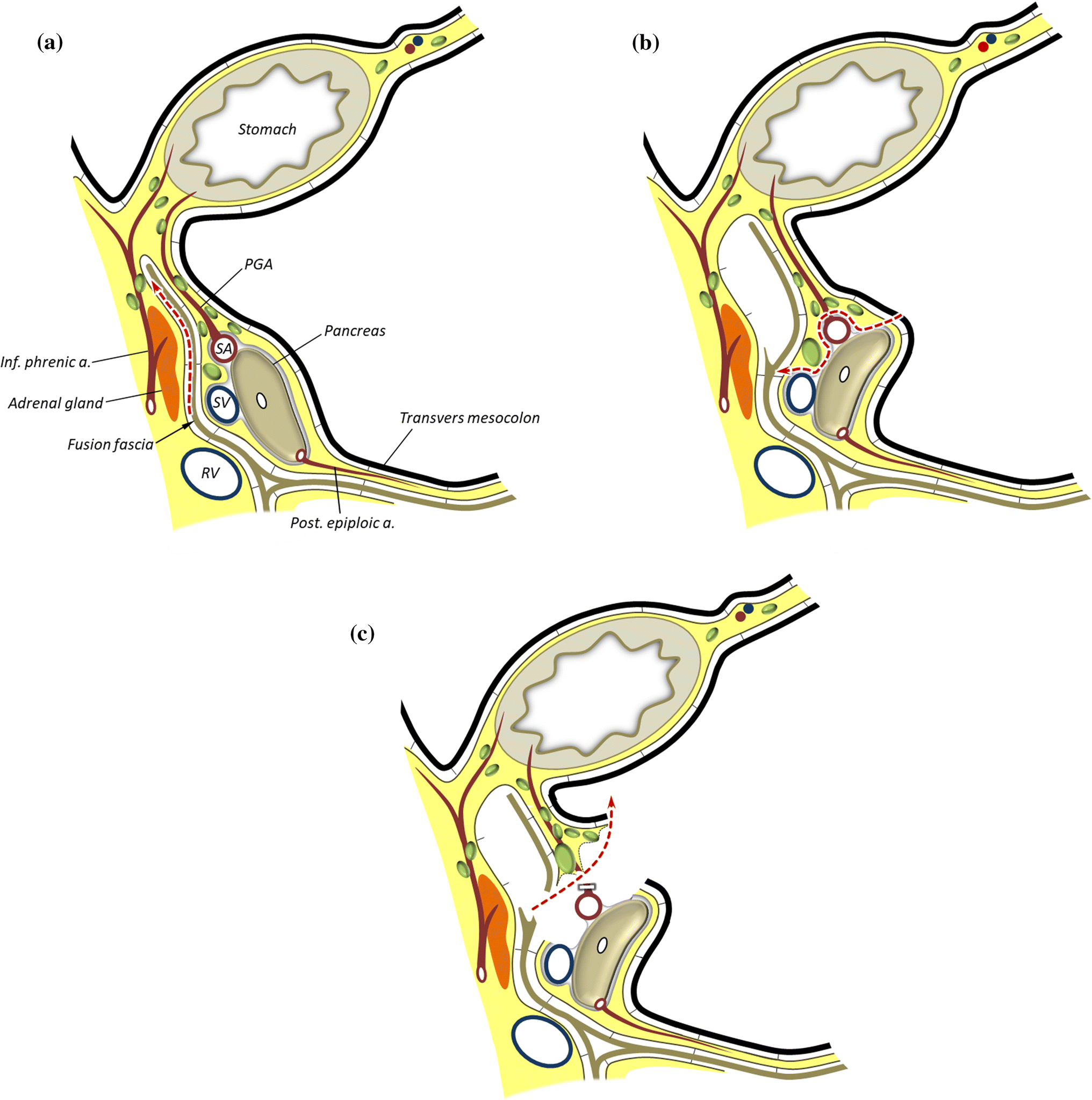 Laparoscopic Suprapancreatic Lymph Node Dissection Using a Systematic ...