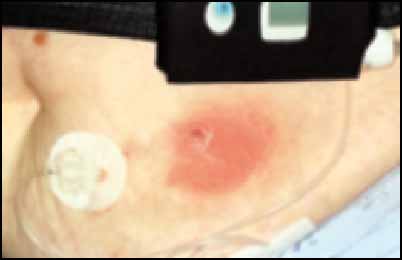 Skin-Related Complications of Insulin Therapy | SpringerLink