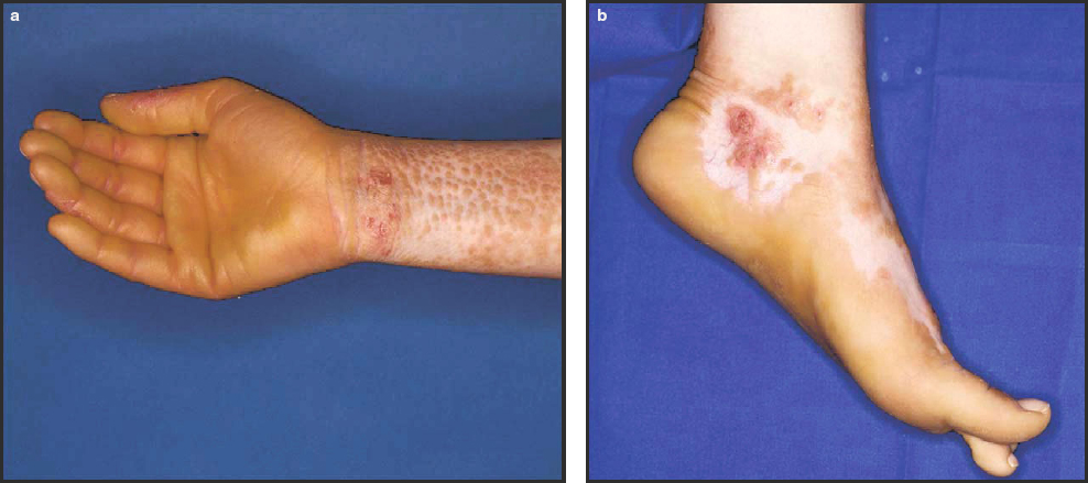 Pityriasis Rubra Pilaris | SpringerLink