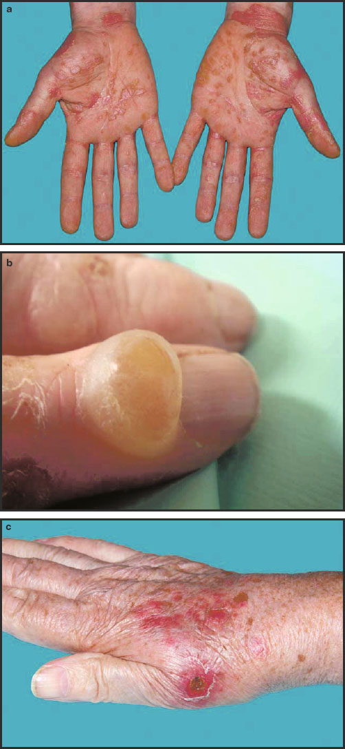 Pompholyx | SpringerLink