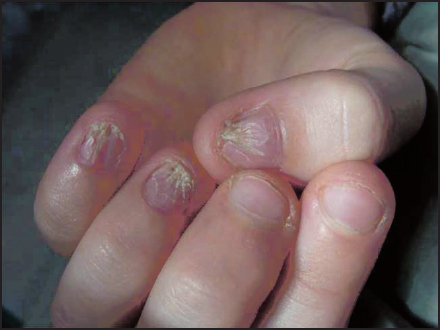 Nail Disorders in Children | SpringerLink