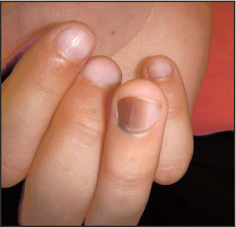 Nail Disorders in Children | SpringerLink
