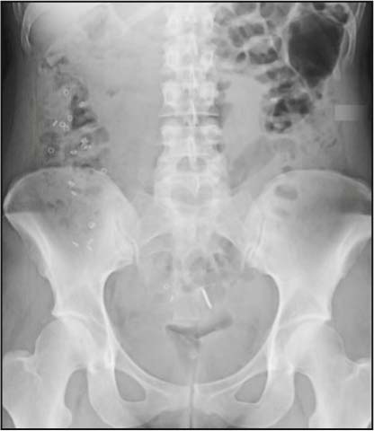 Opioid-Induced Bowel Dysfunction | SpringerLink