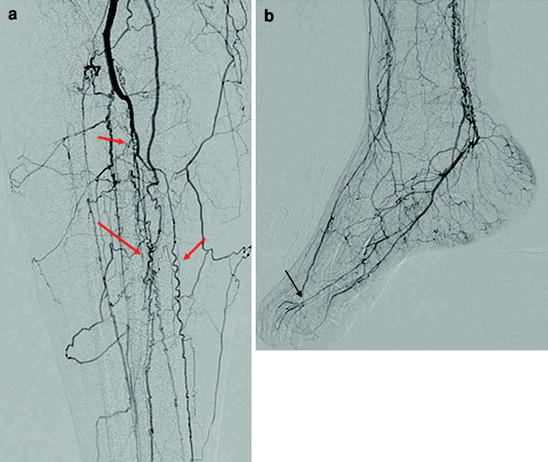 Thromboangiitis Obliterans or Buerger's Disease | SpringerLink