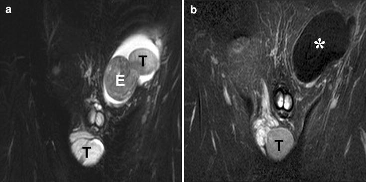 Scrotal Anatomy at MRI | SpringerLink