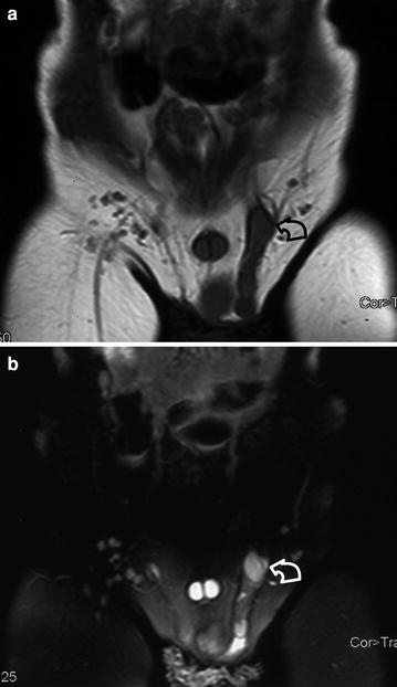 Imaging the Undescended Testis | SpringerLink
