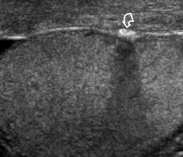 Incidental Scrotal Findings at Imaging-1: Calcifications | SpringerLink