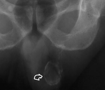 Incidental Scrotal Findings at Imaging-1: Calcifications | SpringerLink