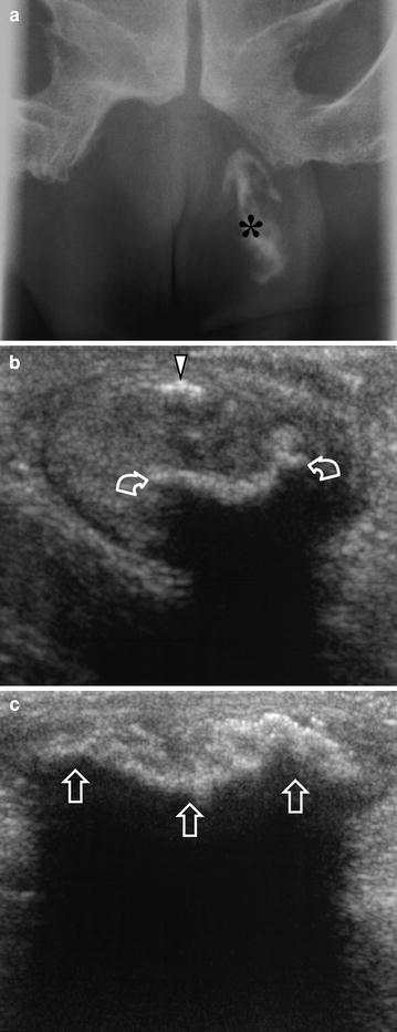 Incidental Scrotal Findings at Imaging-1: Calcifications | SpringerLink