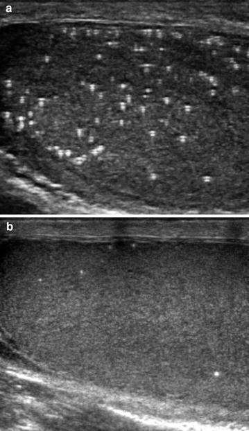 Incidental Scrotal Findings at Imaging-1: Calcifications | SpringerLink
