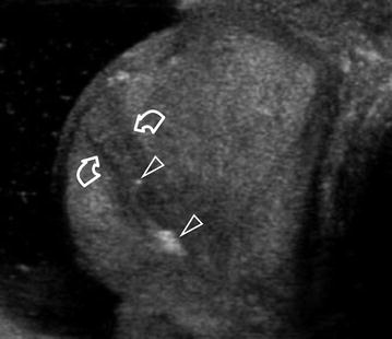 Incidental Scrotal Findings at Imaging-1: Calcifications | SpringerLink