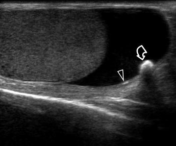Incidental Scrotal Findings at Imaging-1: Calcifications | SpringerLink