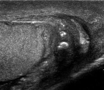 Incidental Scrotal Findings at Imaging-1: Calcifications | SpringerLink