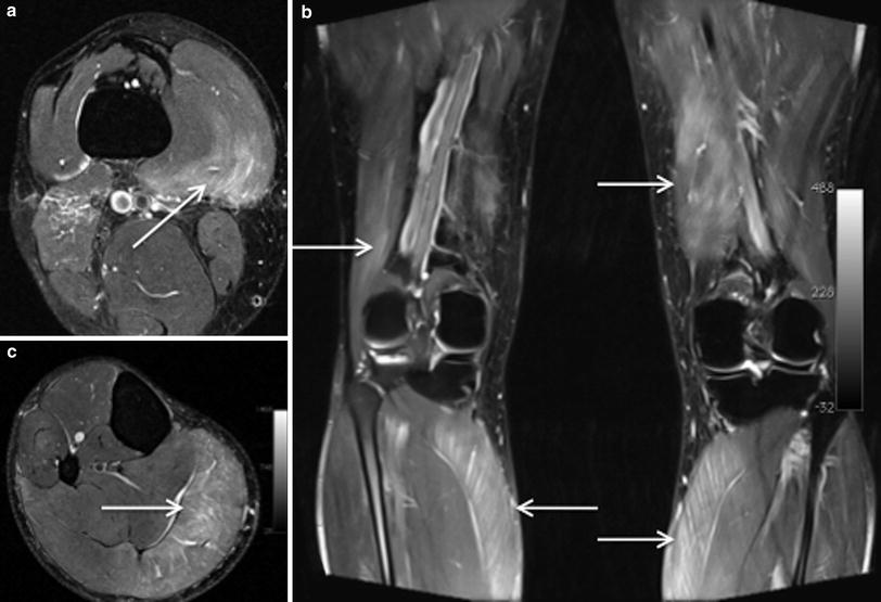 MRI of Muscle Injuries | SpringerLink