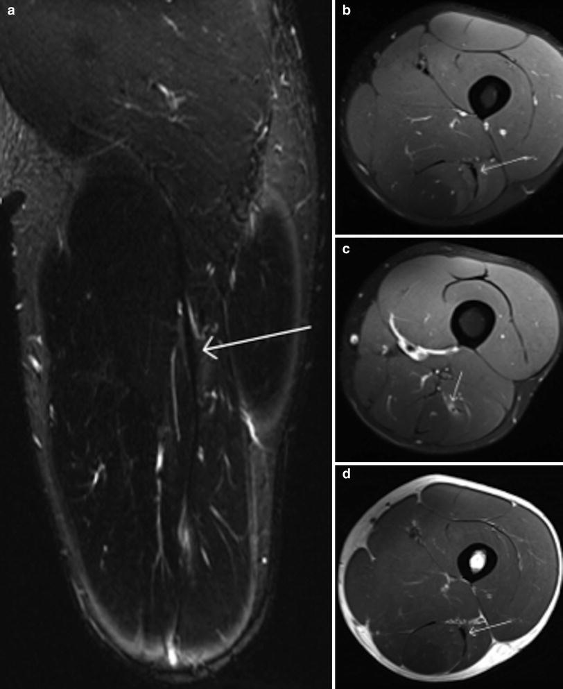 MRI of Muscle Injuries | SpringerLink