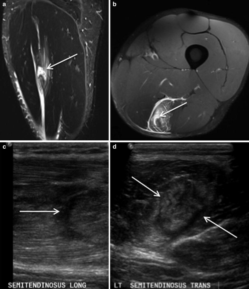 MRI of Muscle Injuries | SpringerLink