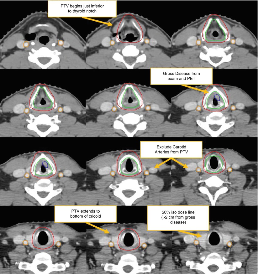 Early Stage Larynx Cancer | SpringerLink