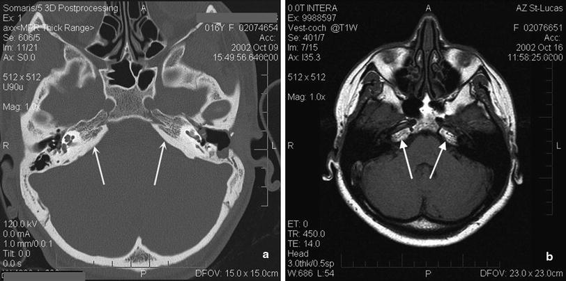 Petrous Apex Lesions | SpringerLink