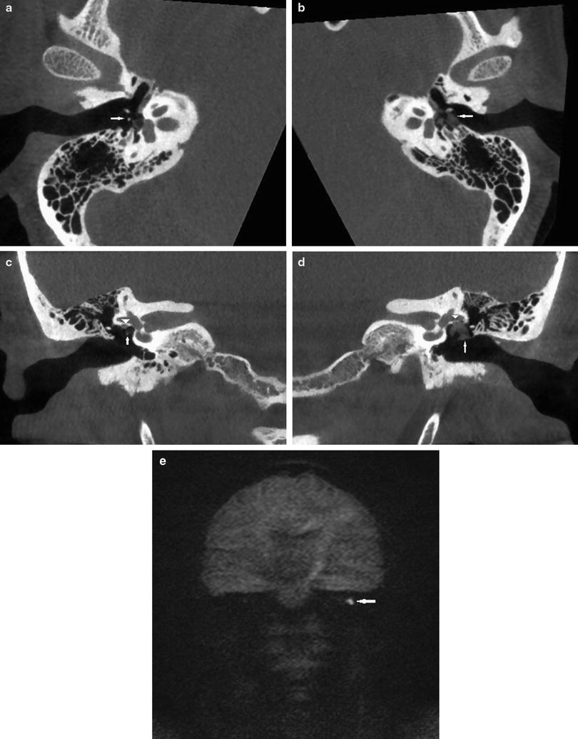 Imaging of Cholesteatoma | SpringerLink