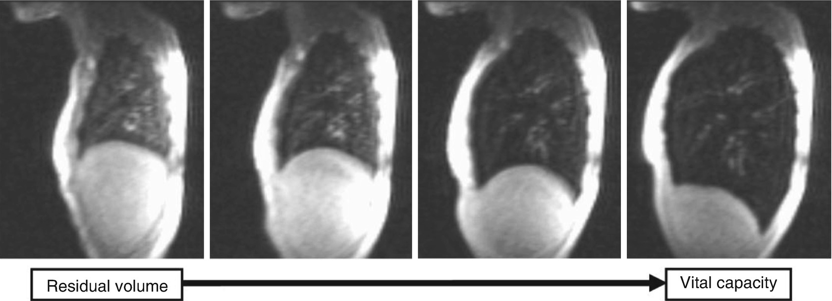 Dynamic MRI of Respiratory Mechanics and Pulmonary Motion | SpringerLink