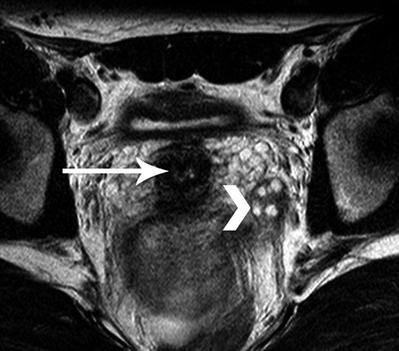 Uterus: Normal Findings | SpringerLink
