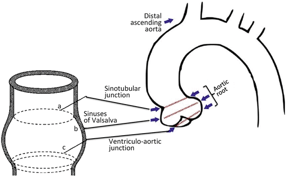 The Relationship Between Aortic Root Size and Hypertension: An Unsolved ...
