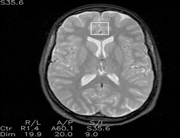 Structural, Functional and Spectroscopic MRI Studies of Methamphetamine ...