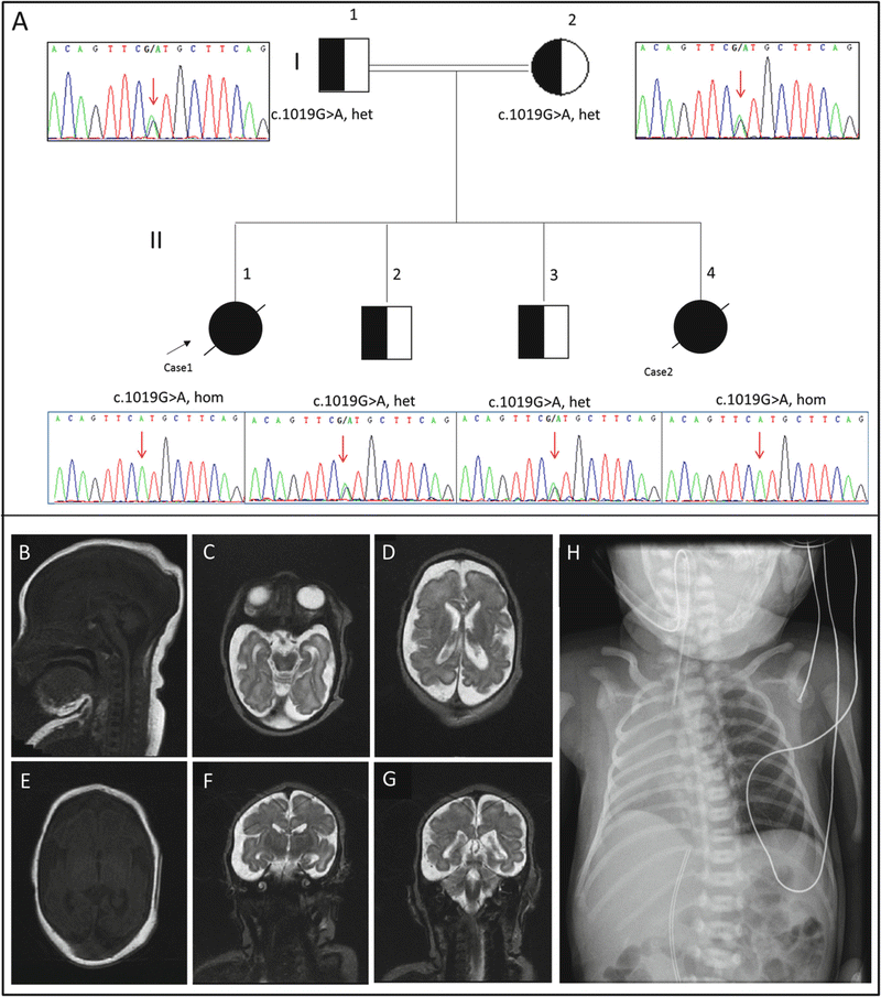 Diaphragmatic Eventration in Sisters with Asparagine Synthetase ...