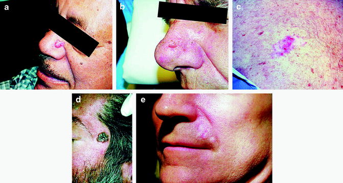 Basal Cell Carcinoma | SpringerLink
