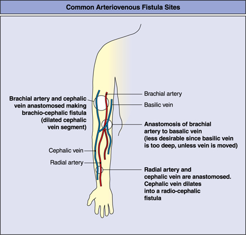 Vascular Access | SpringerLink