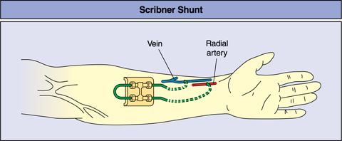 Vascular Access | SpringerLink