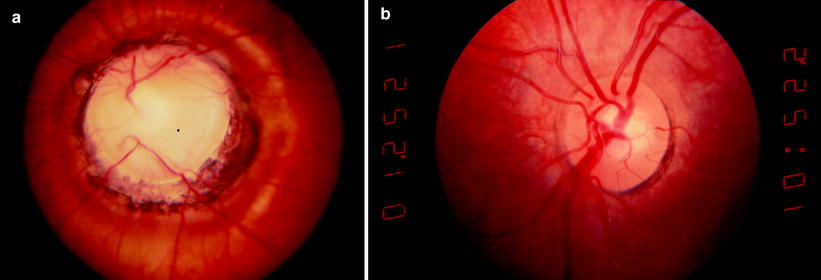 Congenital Optic Disc Anomalies | SpringerLink