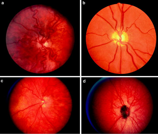 Congenital Optic Disc Anomalies | SpringerLink