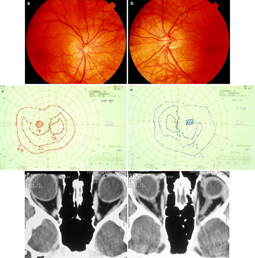 Congenital Optic Disc Anomalies | SpringerLink