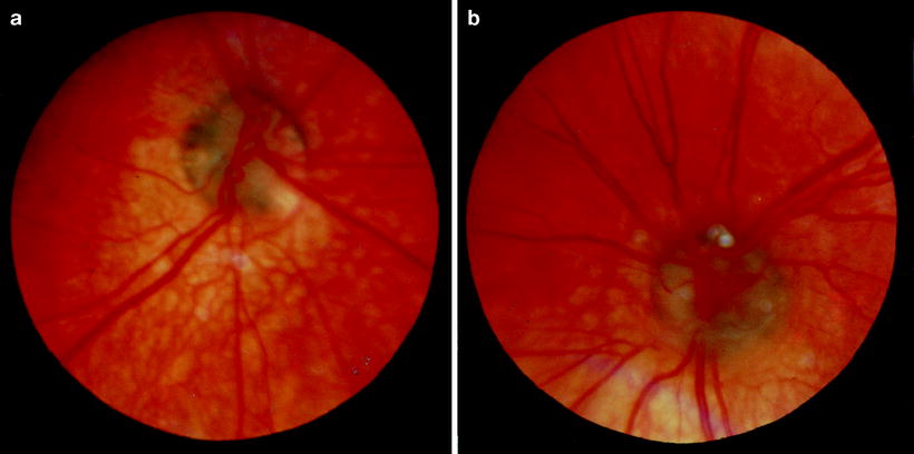 Congenital Optic Disc Anomalies | SpringerLink