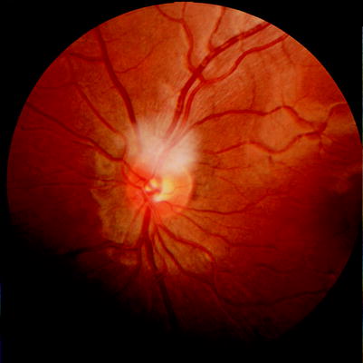Congenital Optic Disc Anomalies | SpringerLink