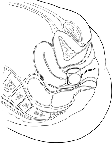 Pessary | SpringerLink